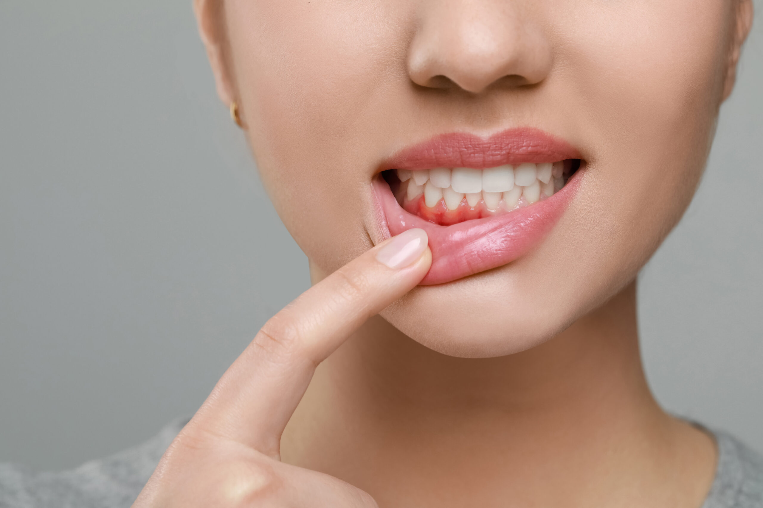 Bleeding Gums: Causes, Treatment and Prevention - Santa Teresa Dental